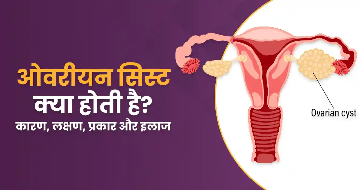 Ovarian Cyst Meaning in Hindi ओवरीयन सिस्ट के कारण, लक्षण, प्रकार और इलाज